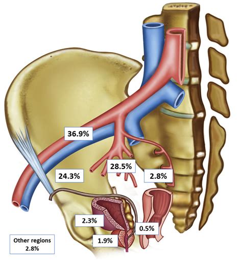 A Areas And Anatomical Distribution Of Lymph Node Metastases N214 Download Scientific A Areas And Anatomical Distribution Of Lymph Node Metastases N214 Download Scientific