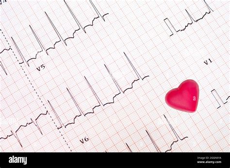 An Abnormal Electrocardiogram Tracing Lateral Wall Ischemia And A Red