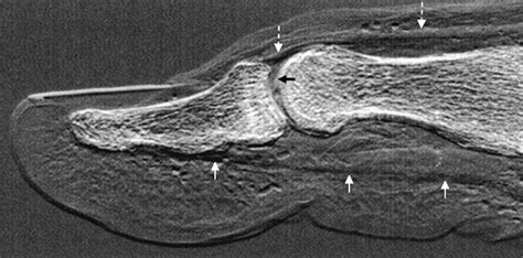 Diffraction Enhanced Imaging Of Musculoskeletal Tissues Using A Conventional X Ray Tube