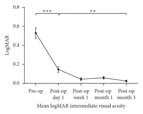 Visual Outcome After The Implantation Of Tecnis® Symfony Iol A