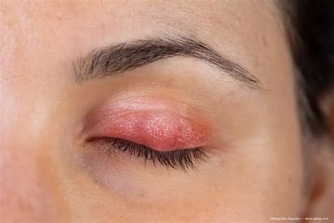 How To Treat Fungal Infection On Eyelid In 2 Weeks