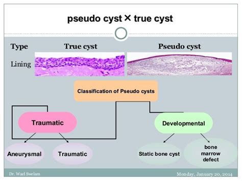 Pseudo Cyst