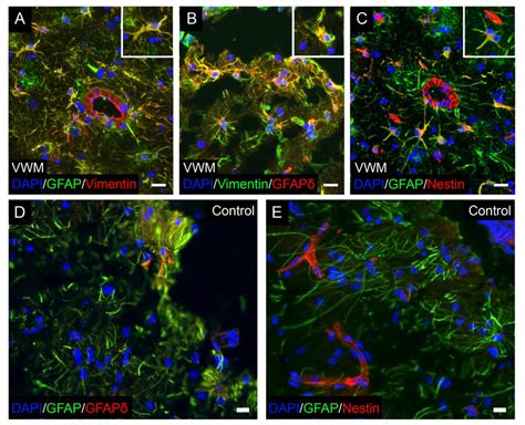 astrocytes in the vwm cortex are immature and have a disrupted