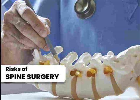 Advanced Spine Surgery Laminectomy TLIF Corpectomy And More DoctorsApp