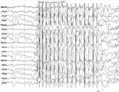 Eeg Example Of Patient 3 With Cae With Typical 3 Hz Spike And Slow Wave Download Scientific