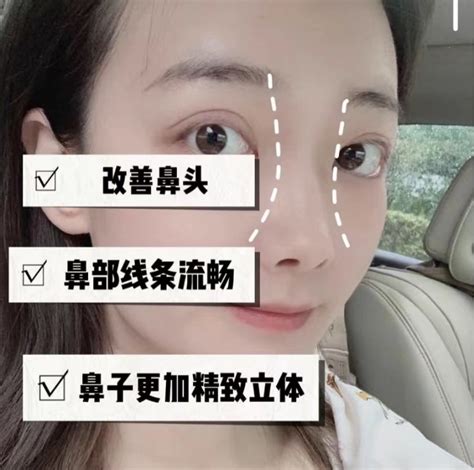 玻尿酸隆鼻的效果有那么好吗？ 知乎