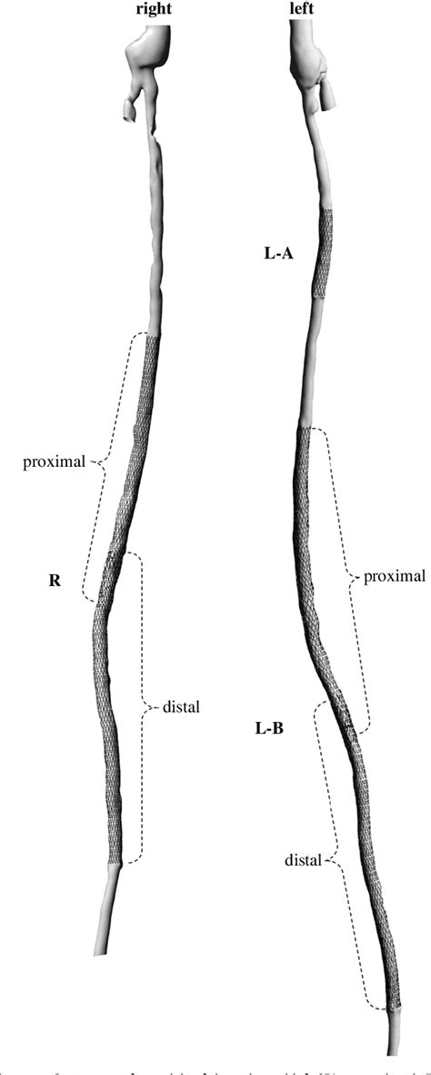 Figure 1 From Predicting 1 Year In Stent Restenosis In Superficial Femoral Arteries Through