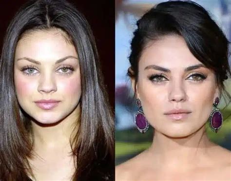 Cheek Implants Before And After Celebrities Results Explained