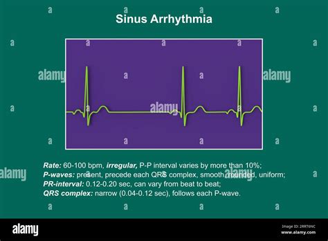 Sinus Arrhythmia
