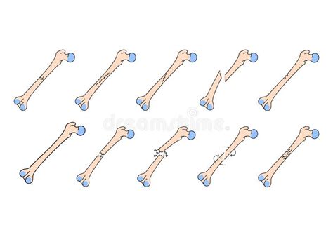 Bone Fracture Line Icons Set Vector Isolated Element Stock Vector Illustration Of Anatomy