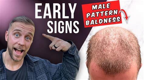 Early Signs Of Male Pattern Baldness What To Look For Youtube