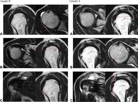 Acromion Types Mri