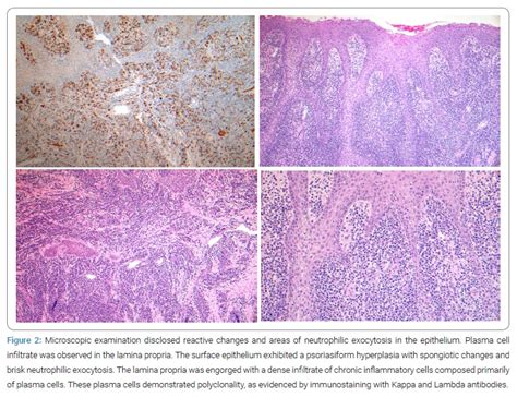 Plasma Cell Gingivitis Pathology Outlines