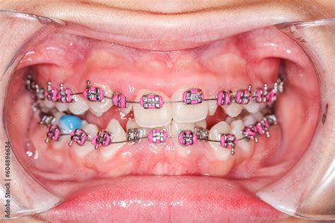 Frontal View Of Dental Arches In Occlusion With Deep Overbite Biting Teeth Bite Raising Blue