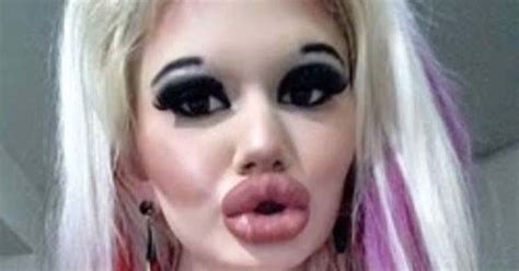 “세계에서 가장 큰 입술 갖고파” 시술에 ‘3700만 원 쓴 女 과거 모습은