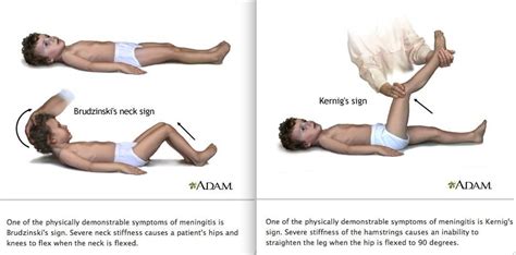 Kernig And Brudzinski Signs