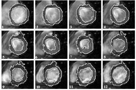 An Example Of Automatic Segmentation Of The Left Ventricle Along Twelve Download Scientific