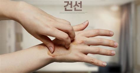 건선 걸리면 자살 경향성 위험도 높아진다