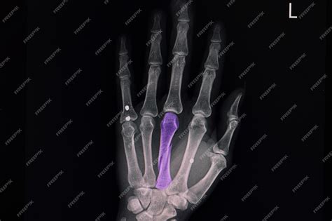 Premium Photo Xray Film Of Spiral Fracture Of Third Metacarpal Bone
