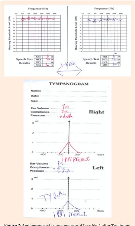 Otitis Media Audiogram Example At Diane Carey Blog