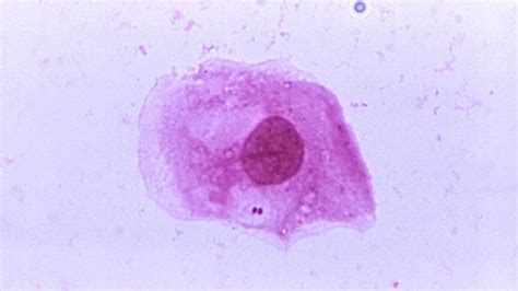Meningococcal Disease Outbreak In Virginia Blamed For 5 Deaths Cnn