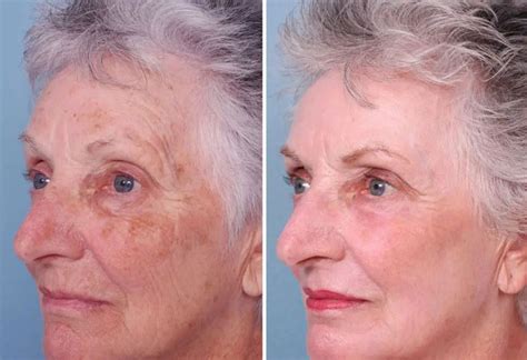 Yag Laser Treatment In Westlake Village Ca Setiba Medical Spa