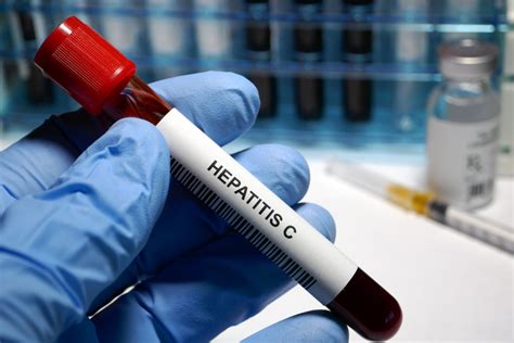 Hepatitis C Sexual Transmission Risk How It Spreads Treatment More Parade
