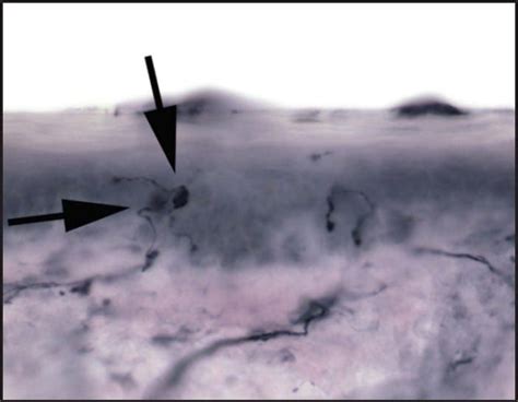 Epidermal Nerve Fiber Density Testing An Overview Bako Diagnostics