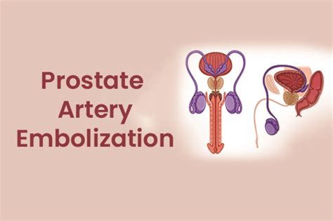 Prostate Artery Embolization Treatment In Ahmedabad Prostatic Treatment Near Me