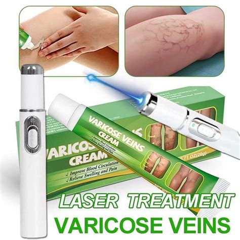 Laser Treatment For Varicose Veins Spider Legs Phlebitis Vasculitis