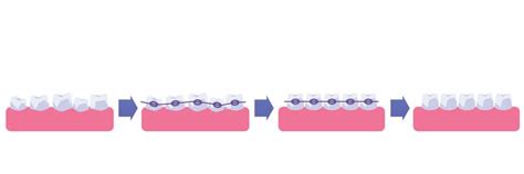 Bite Correction And Teeth Aesthetics With Braces Vector Image