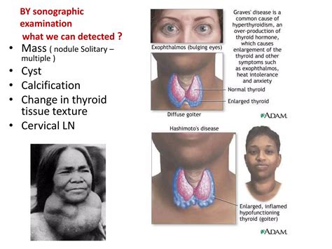Thyroid Lesions Evaluation With Sonography Ppt