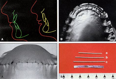 A With Relapse Of Deep Overbite Incisal Edges Of Mandibular Incisors