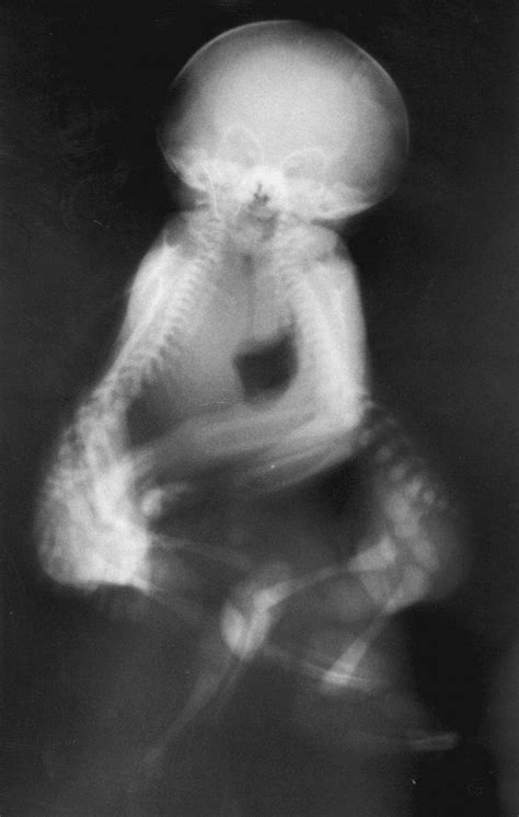 Extremely Rare Type Of Conjoined Twins Cephalothoracopagus