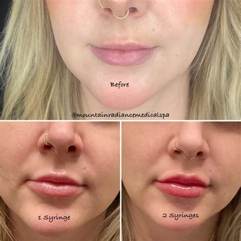 Restylane Vs Juvéderm Which One Is Best For Me Mountain Radiance