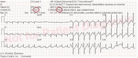Ecg Solution Get To The Point