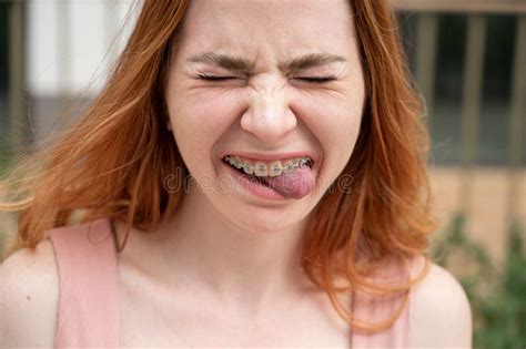 Young Woman With Braces On Her Teeth Smiles And Shows Her Tongue
