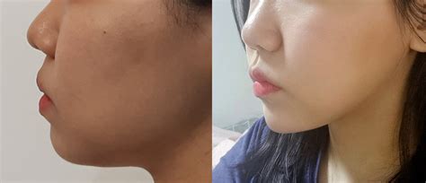 얼굴지방흡입파워v V라인앞볼 얼굴민트실리프팅 턱끝필러 자갈턱보톡스 7개월차 후기 닥터정 리반의원