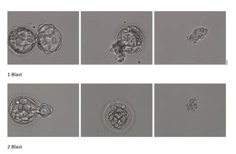 Trophectoderm Biopsy What Is It — Reprolife