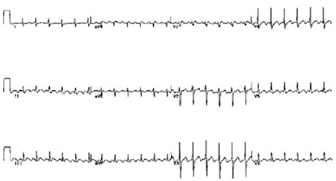 Atrial Flutter Sawtooth Ecg