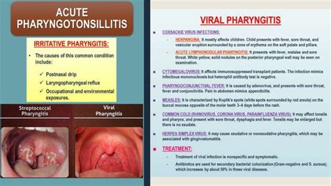 Adeno Tonsillar Diseases Pptx Ear Nose And Throat Conditions