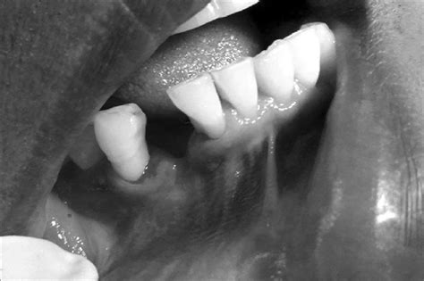 Clinical Image Of Seiberts Class Iii Alveolar Ridge Defect Involving Download Scientific