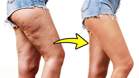 КАК ИЗБАВИТЬСЯ ОТ ЦЕЛЛЮЛИТА НАВСЕГДА ЗА КОРОТКОЕ ВРЕМЯ Youtube