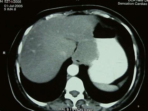 Gist Gastrointestinal Stromal Tumor Ppt Digestive Disorders Diseases And Conditions