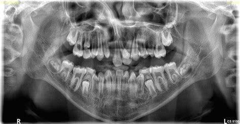 Liketeeth Segmentation 18aanteeth Identification Roboflow Universe