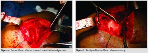 Femoral Head Reduction Osteotomy For Deformed Perthes Head Using Ganz