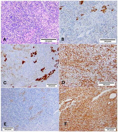A Novel Pathogenic Variant Of Dicer1 Gene In A Young Greek Patient With 2 Different Sex Cord
