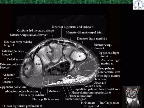 Anatomy And Imaging Of Wrist Joint Mri And Xray Pptx