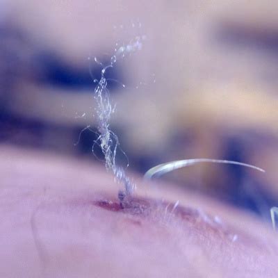 Blue Fibers In Skin