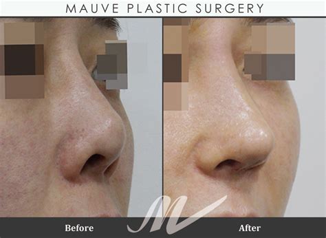 코성형 부작용 구축코 개선사례 코재수술 콧대코끝연골묶기코속살제거 성형외과 전문의 칼럼 코성형 가슴성형 수술